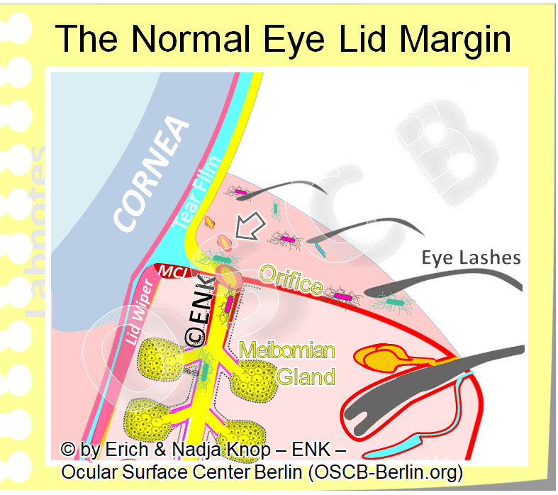 OVERVIEW of Contact Lenses — Ocular Surface Center Berlin
