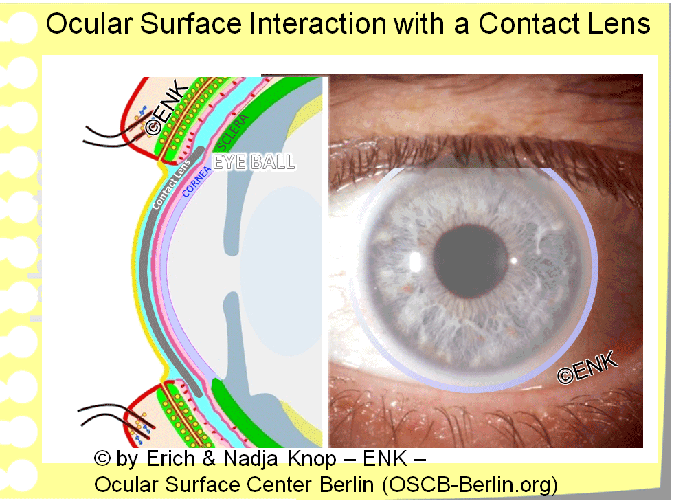 DEEPER INSIGHT into ... Contact Lenses - HISTORY - TYPES - SCHEDULES - FITTING — Ocular Surface ...