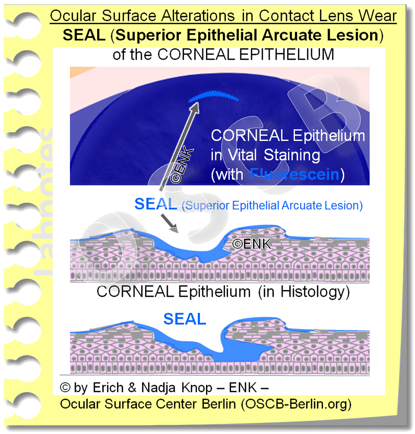 Contact Lens Discomfort (CLD) — Ocular Surface Center Berlin