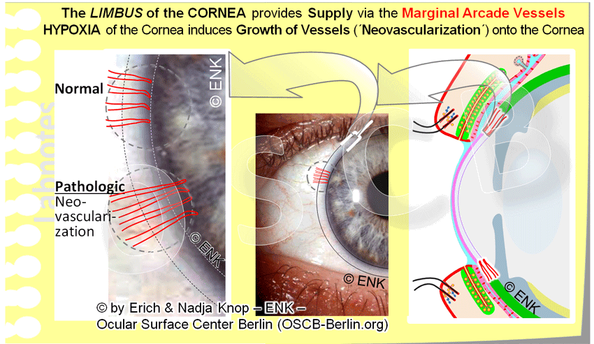 The CORNEA — Ocular Surface Center Berlin
