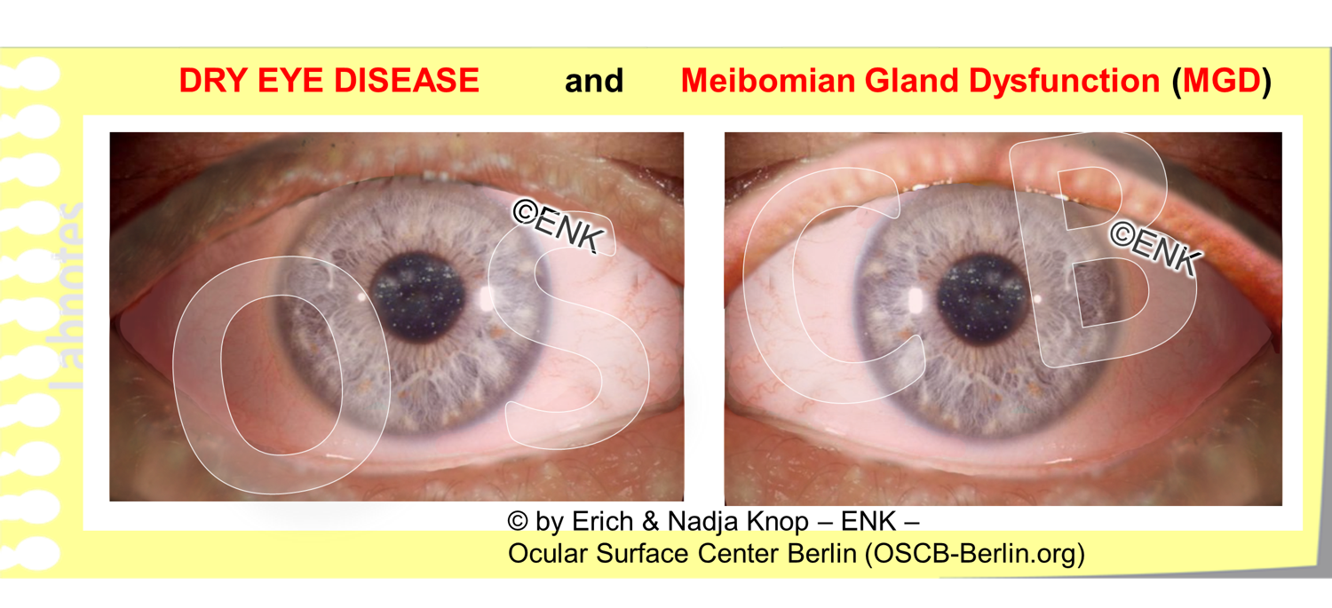 ES-0-HOME — Ocular Surface Center Berlin