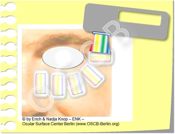 ENGLISCH IPL Meibomian Glands - IPL - Intense Pulsed Light-Therapy ...