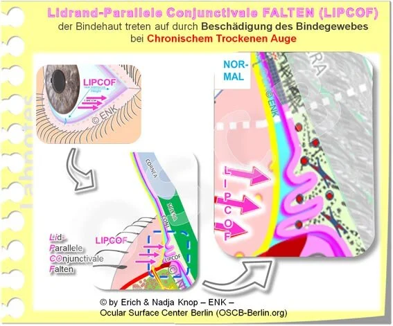 DIAGNOSTIK - Woran erkenne ich ein Trockenes Auge ? — Ocular Surface ...