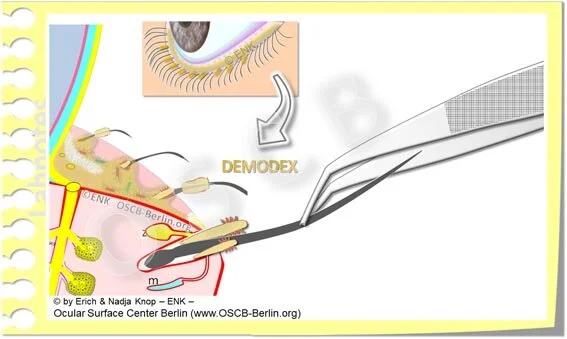 LID INFLAMMATION/Blepharitis - DEMODEX — Ocular Surface Center Berlin