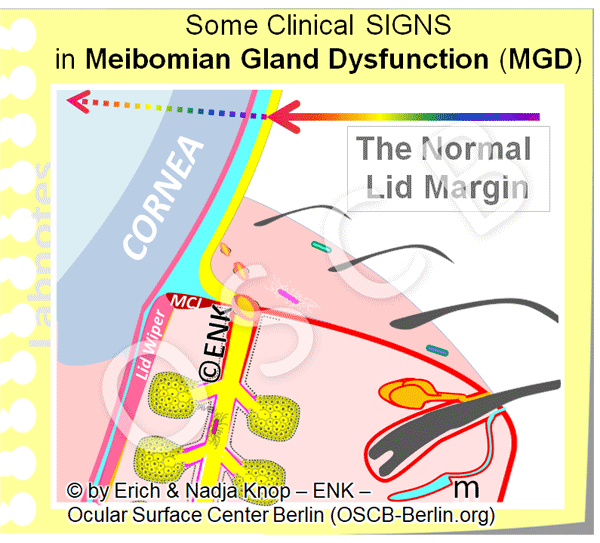 MEIBOMIAN GLAND Dysfunction - Oil Deficiency - Dry Eye — Ocular Surface ...