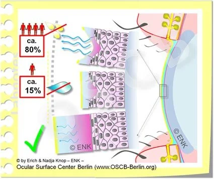 ESSENTIALS for Dry Eyes — Ocular Surface Center Berlin