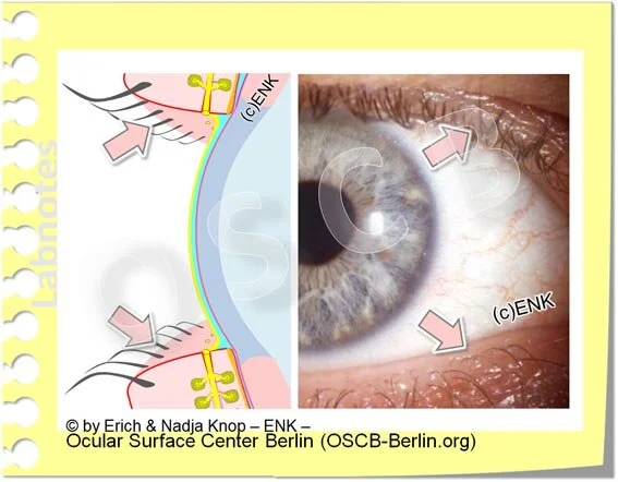 Overview On The Lid Margin — Ocular Surface Center Berlin