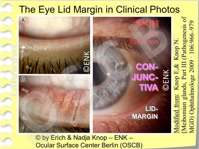 Eyelid Margin Structure: Eyelid Margin Chart – HOBH