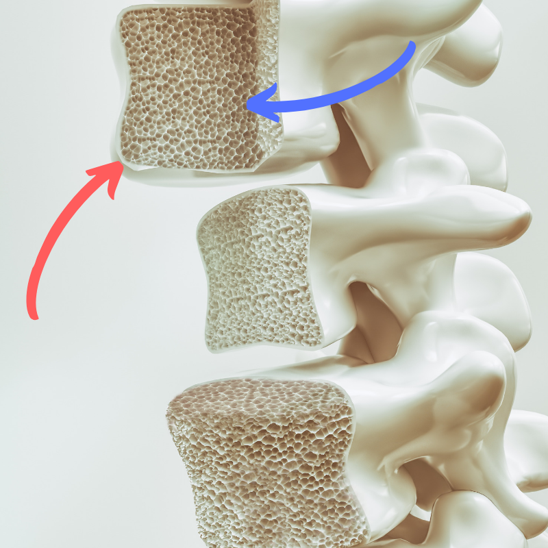 How Bad Posture Can Lead to Compression Fractures — Newmarket ...