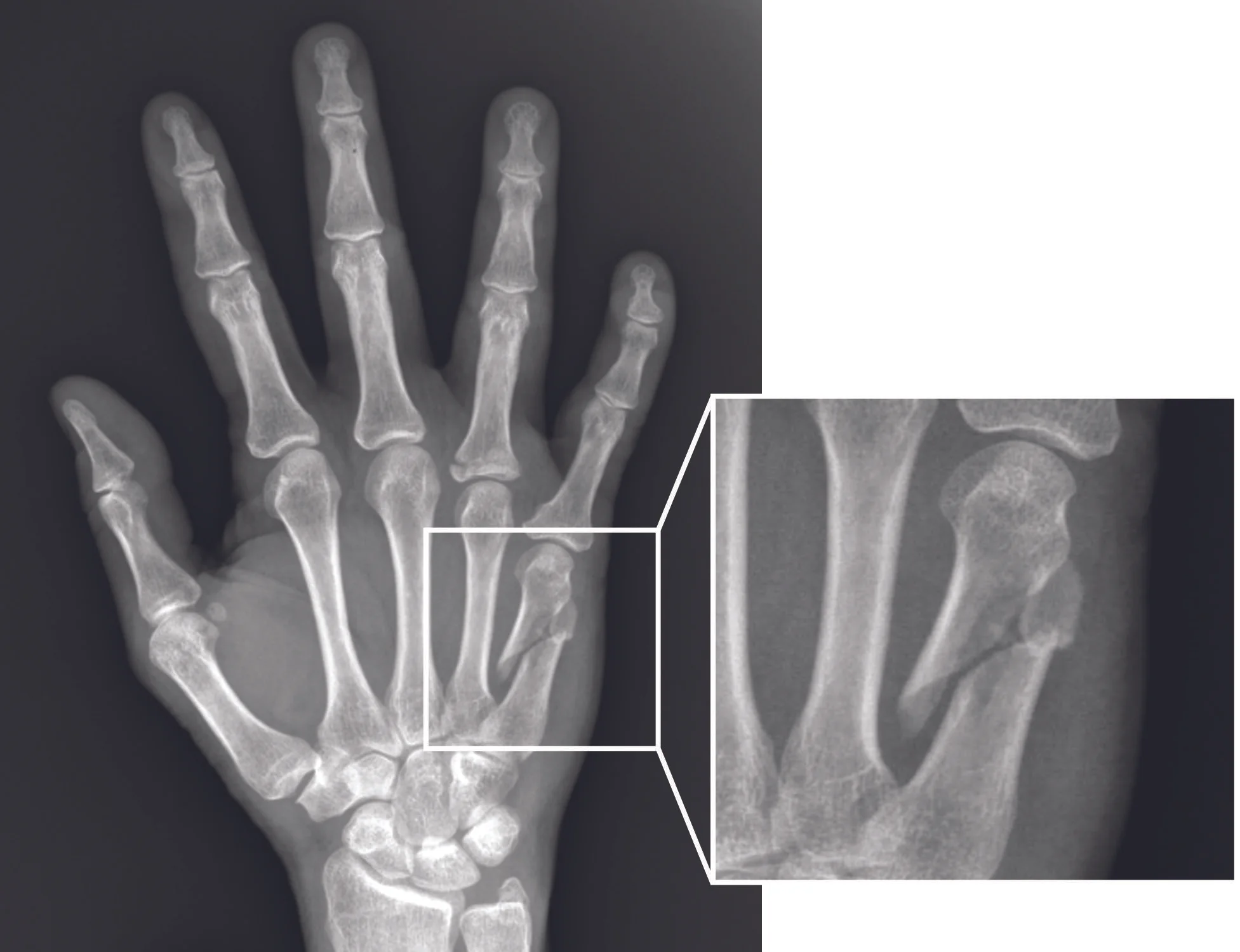 Hand Fracture Raleigh Hand Surgery Joseph J Schreiber MD