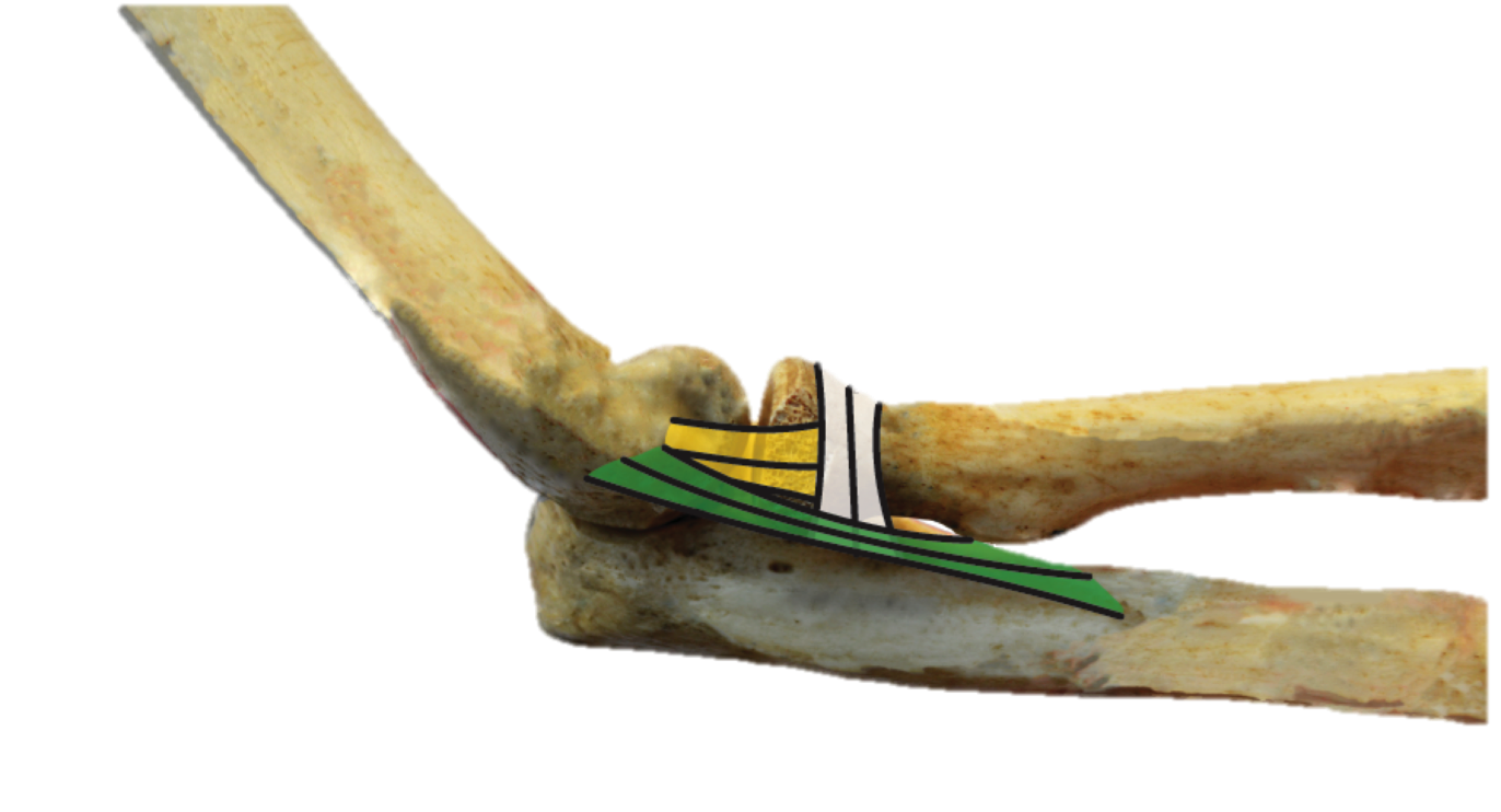 Elbow Dislocation - Raleigh Hand Surgery — Joseph J. Schreiber, MD