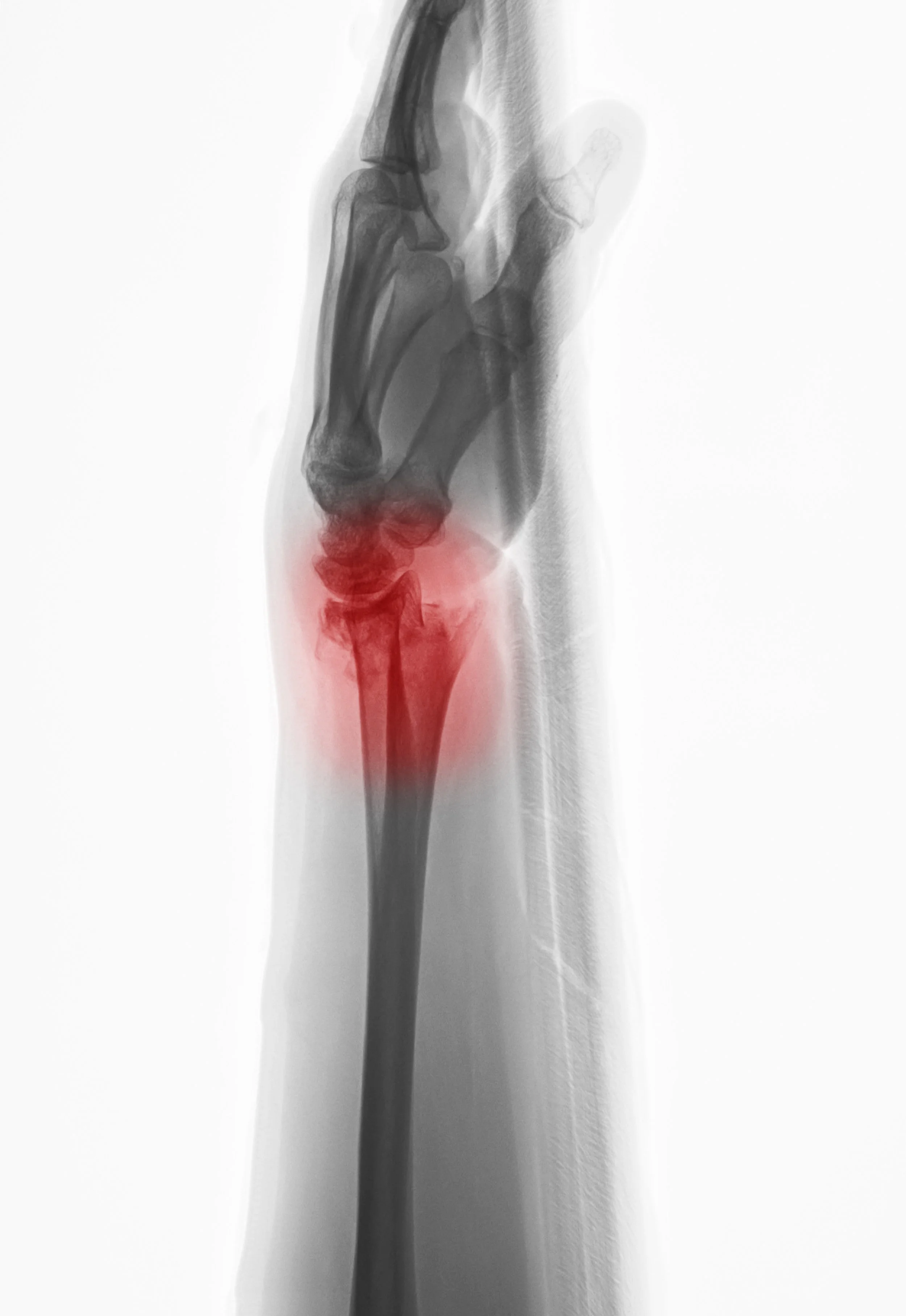 Distal Radius Fracture - Raleigh Hand Surgery — Joseph J. Schreiber, MD