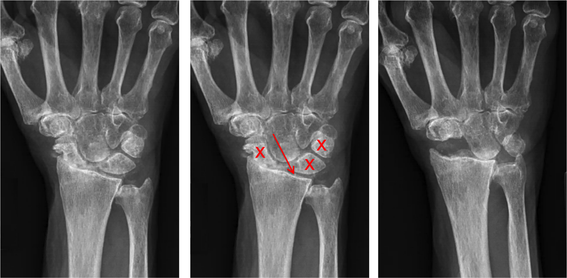 Wrist Arthritis Raleigh Hand Surgery Joseph J Schreiber MD