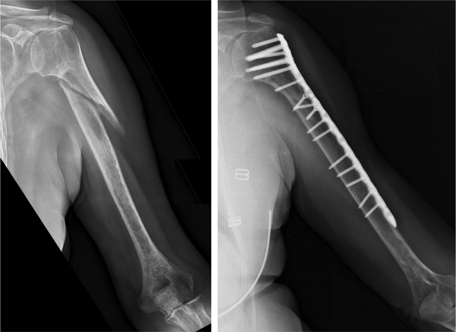 Humerus Fracture Joseph J Schreiber MD Humerus Fracture Joseph J Schreiber MD
