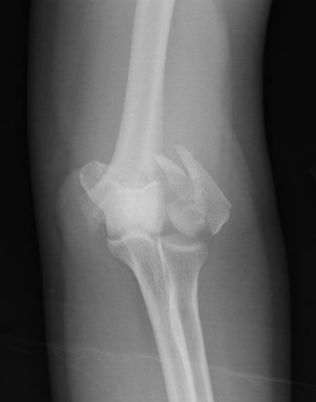 Humerus Fracture — Joseph J. Schreiber, MD