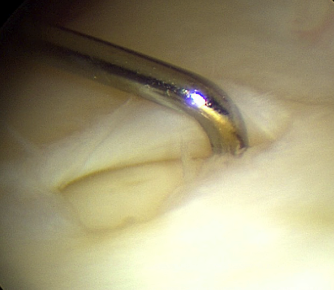 TFCC Tear - Raleigh Hand Surgery — Joseph J. Schreiber, MD