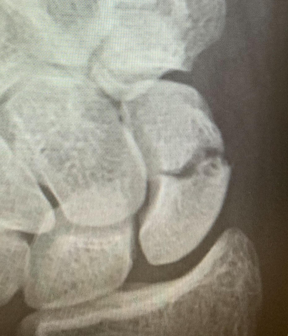 Scaphoid Fracture - Raleigh Hand Surgery — Joseph J. Schreiber, MD