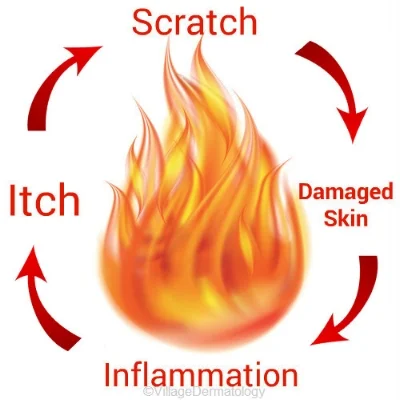 Symptoms of Eczema — Village Dermatology