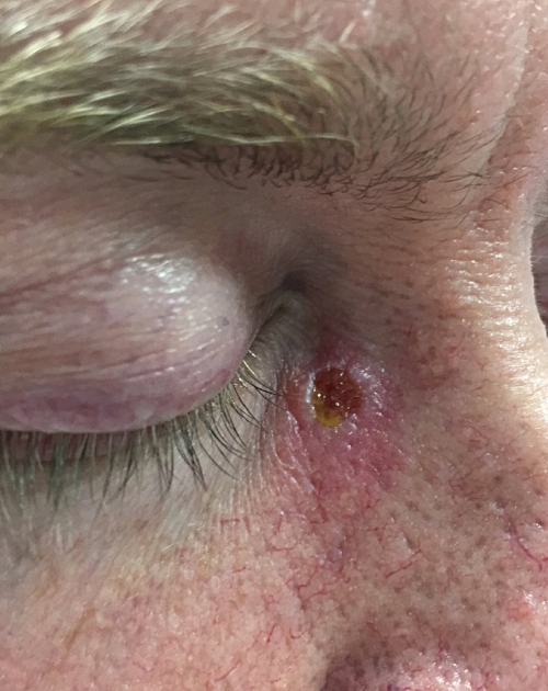 Basal Cell Carcinoma — Village Dermatology