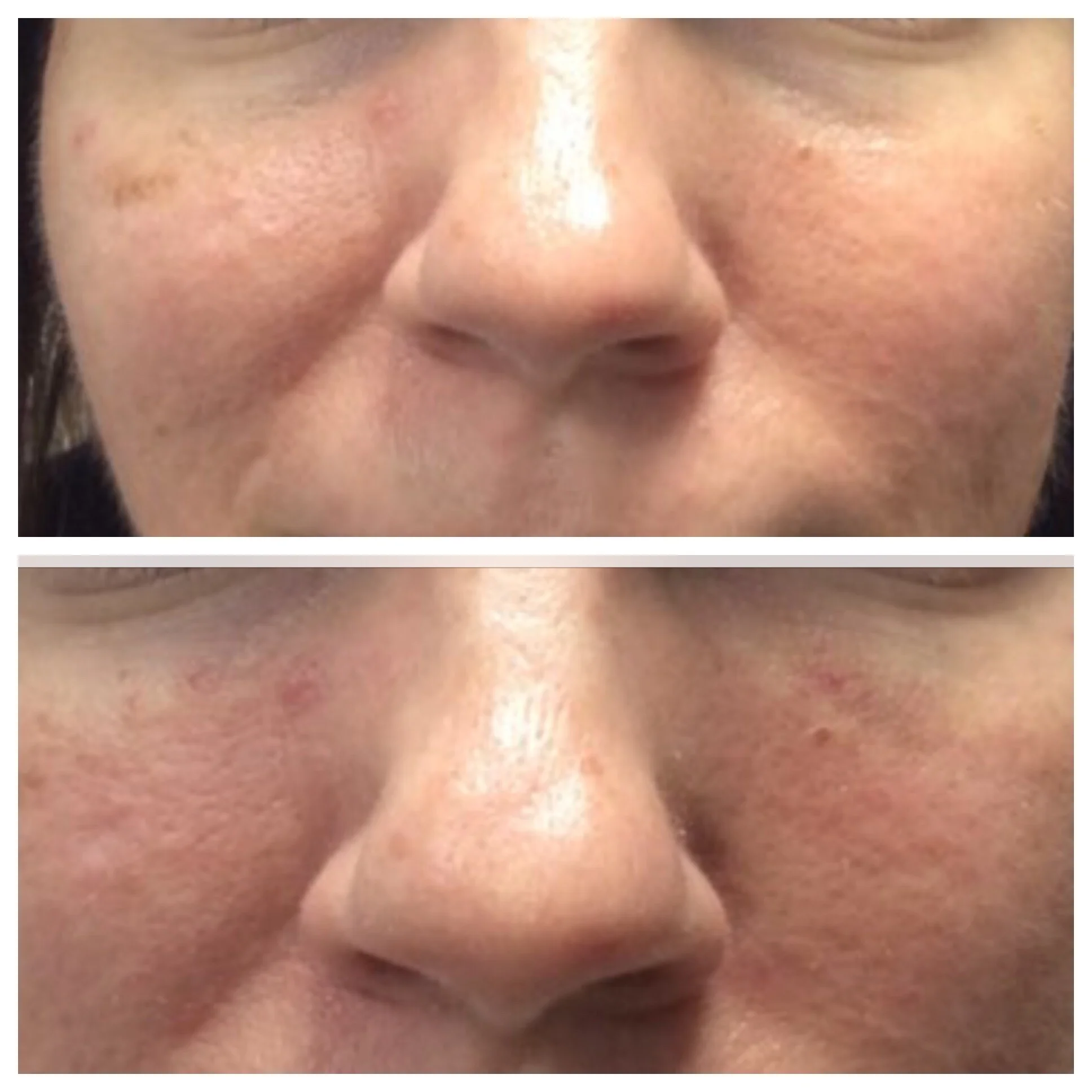 Restylane and Silk — Village Dermatology