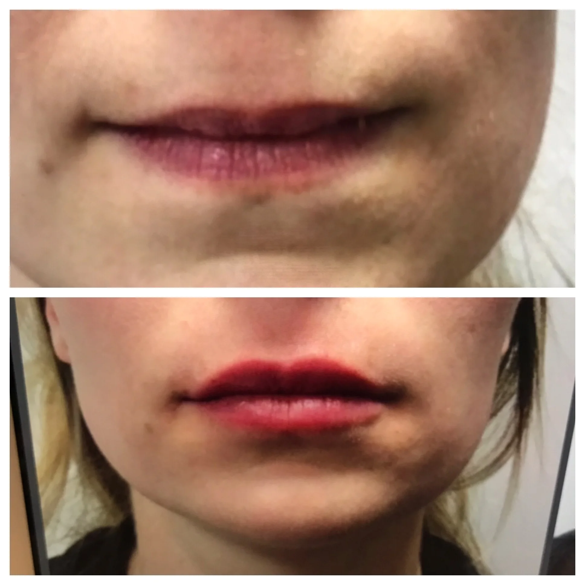 Restylane and Silk — Village Dermatology