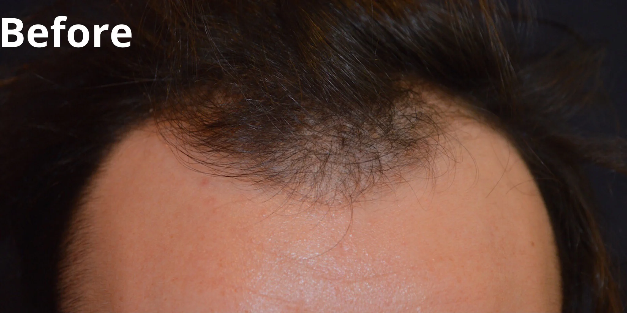 Hair Restoration Beverly Hills | Hair Transplant - Dr. Jason Champagne ...