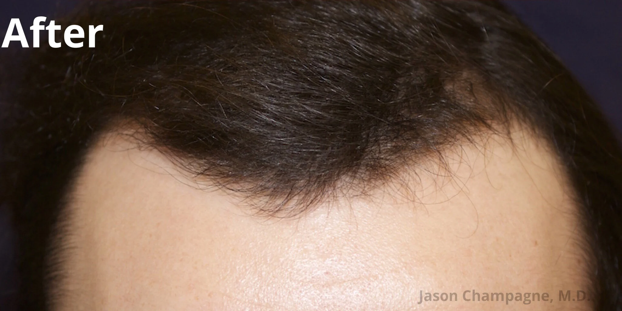 Hair Restoration Beverly Hills | Hair Transplant - Dr. Jason Champagne ...