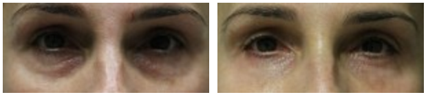 Customized Facial Contouring Fillers Gallery | Beverly Hills Plastic ...