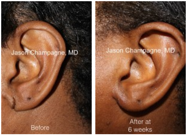 Earlobe Reconstruction Gallery | Beverly Hills Plastic Surgeon - Dr ...