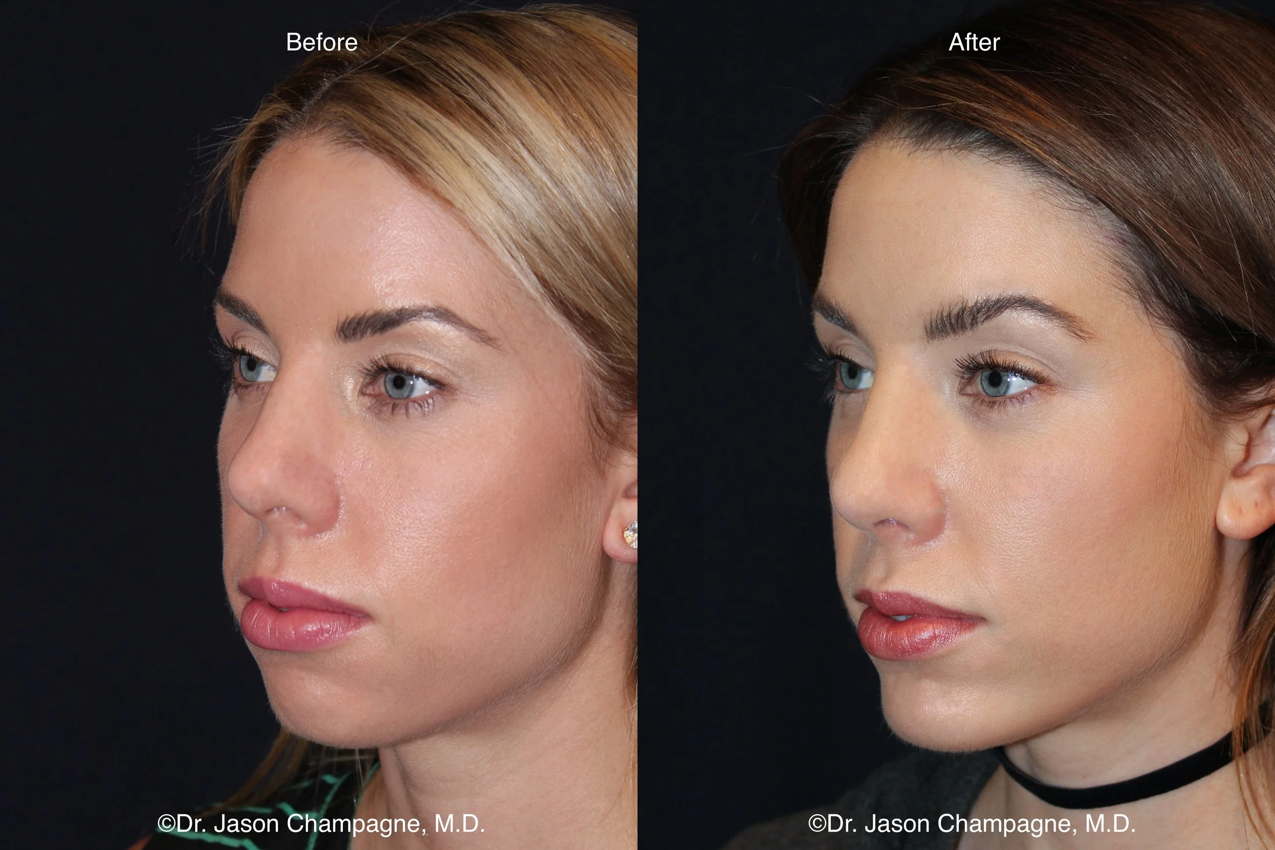 Chin Implant Gallery | Beverly Hills Plastic Surgeon - Dr. Jason Champagne