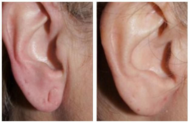 Don't Forget Your Ears: Earlobe Reconstruction and Otoplasty (Ear ...