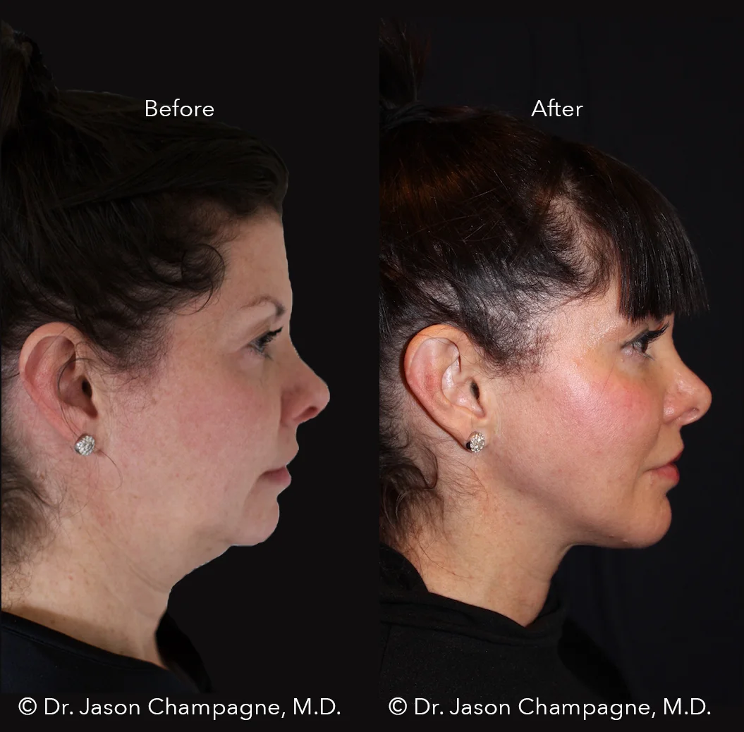 Chin Implant | Beverly Hills Plastic Surgeon - Dr. Jason Champagne