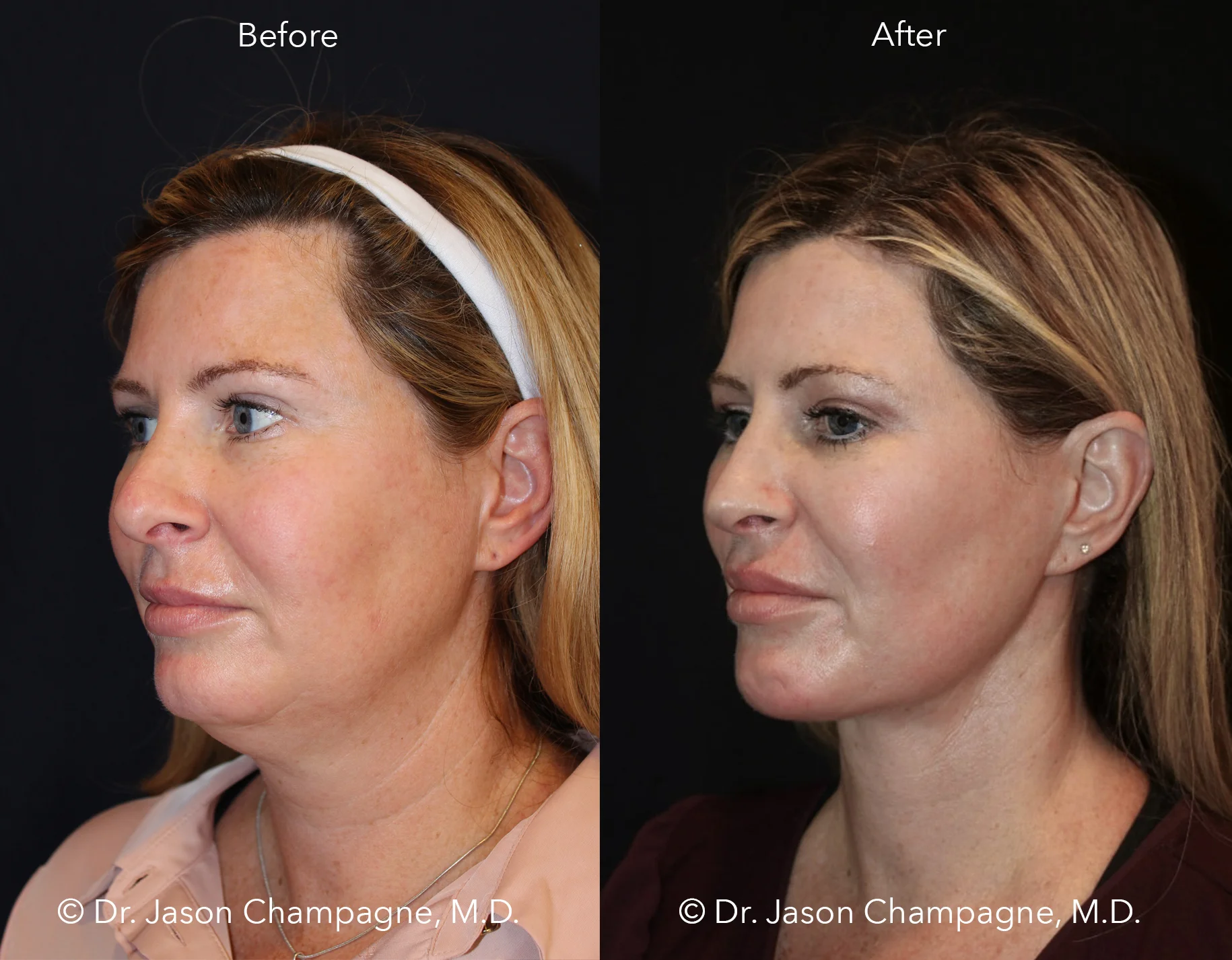 Chin Implant Gallery | Beverly Hills Plastic Surgeon - Dr. Jason Champagne