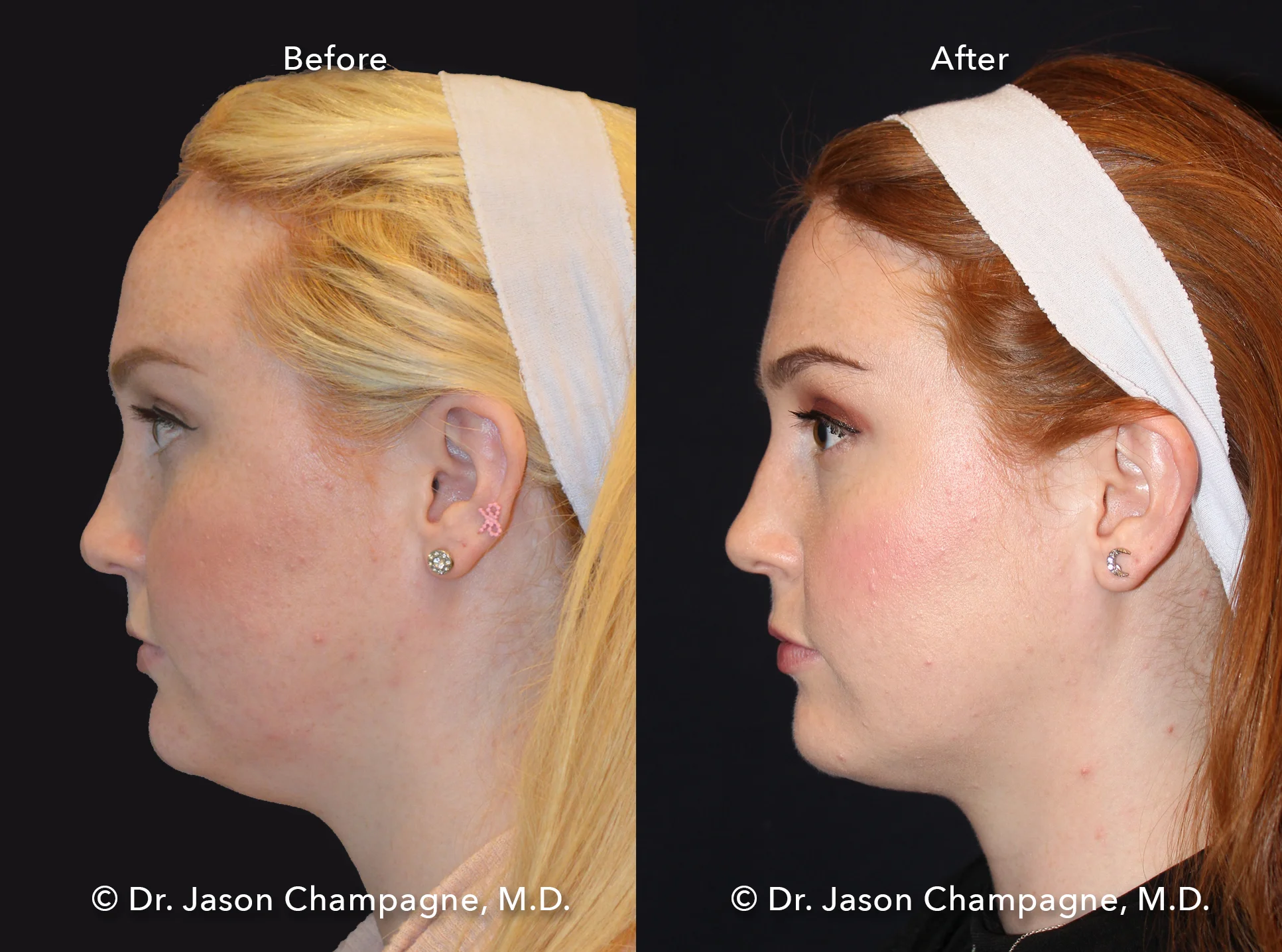 Hairline Lowering Gallery | Beverly Hills Plastic Surgeon - Dr. Jason ...