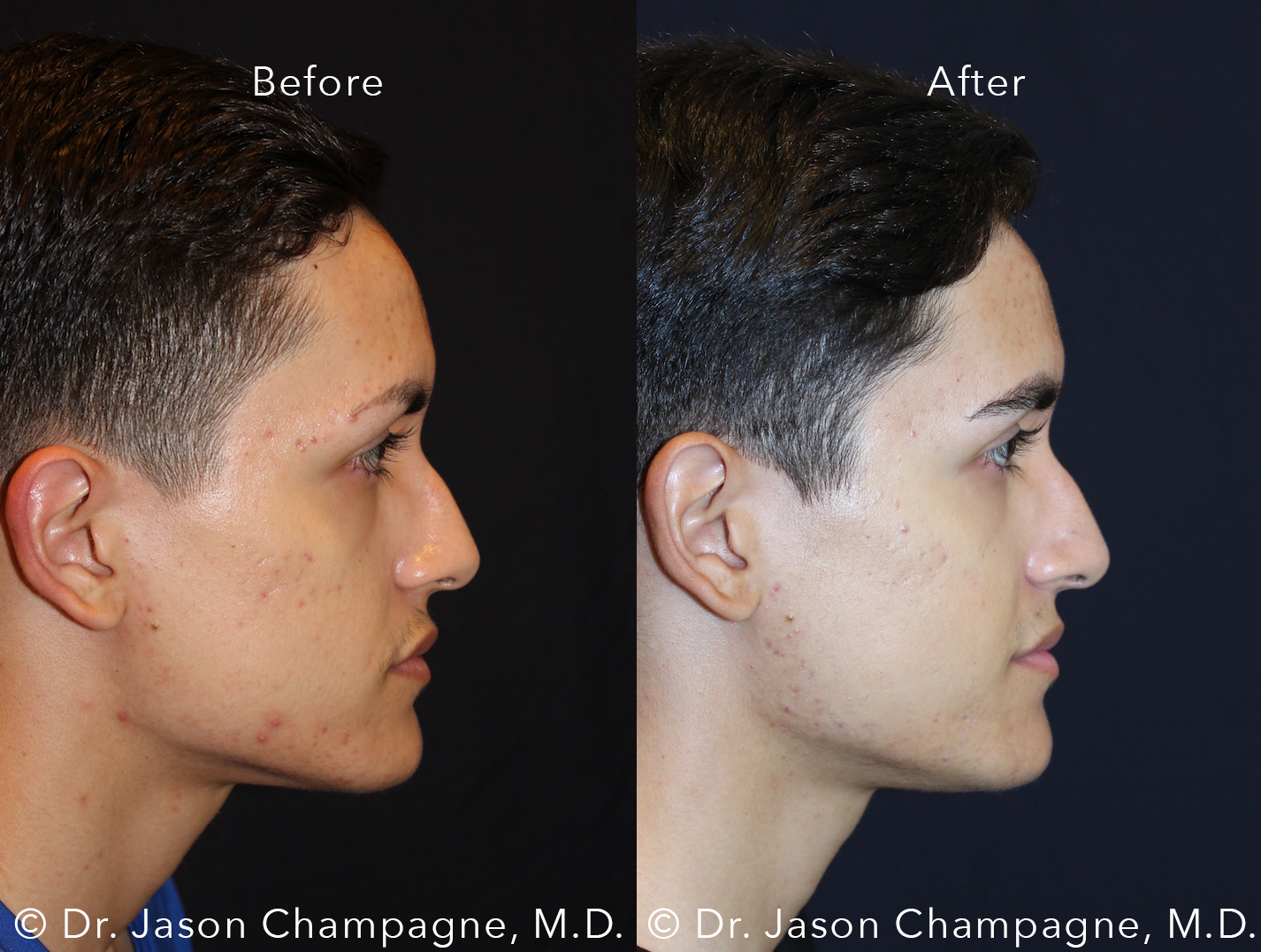 Eyebrow Hair Transplantation Gallery | Beverly Hills Plastic Surgeon ...