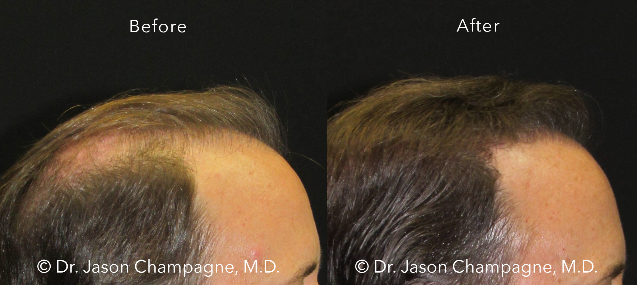Hair Transplantation Gallery | Beverly Hills Plastic Surgeon - Dr ...