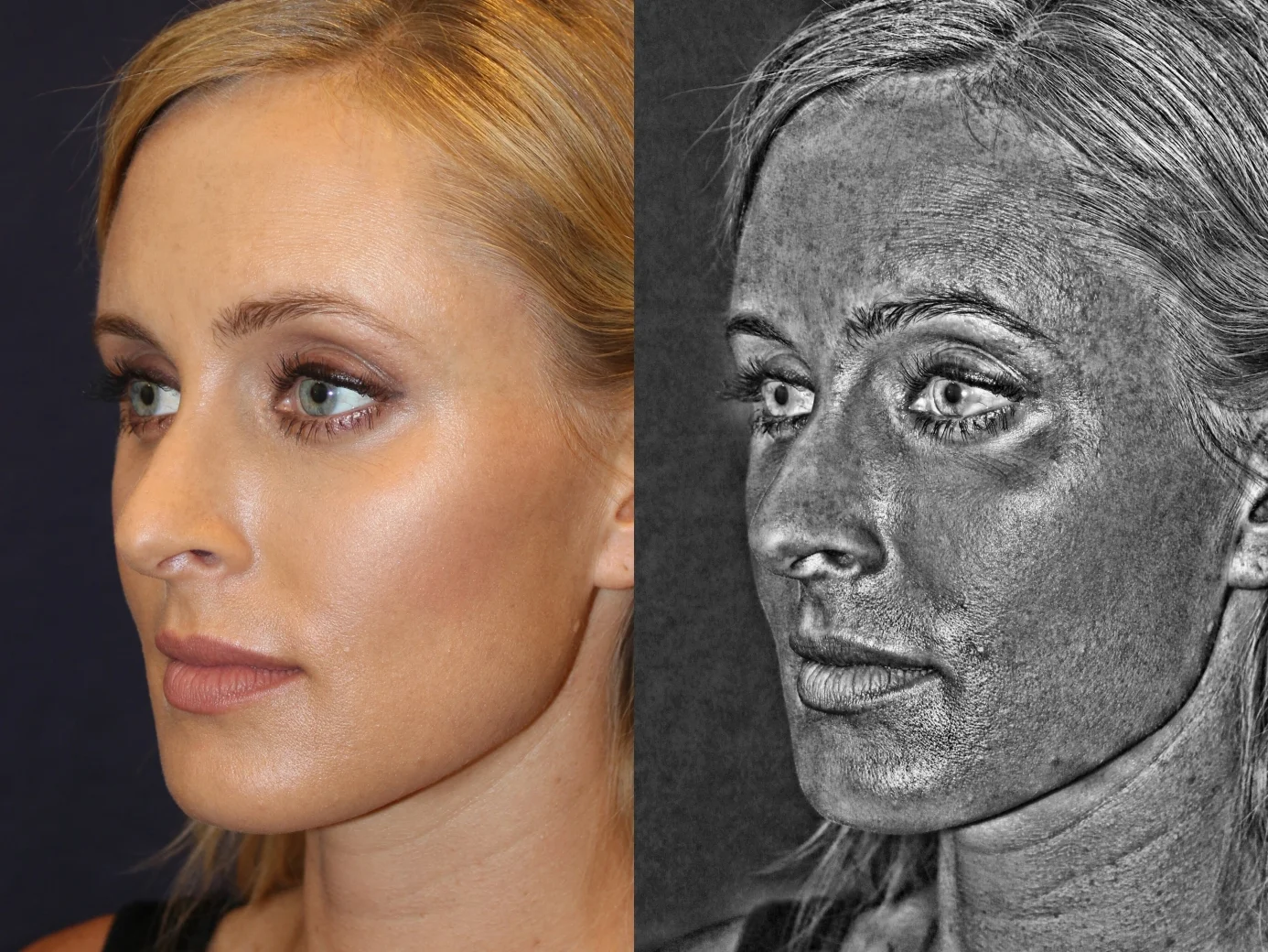 Bright & Tight Skin Therapy: Fractionated Radio-Frequency Skin ...