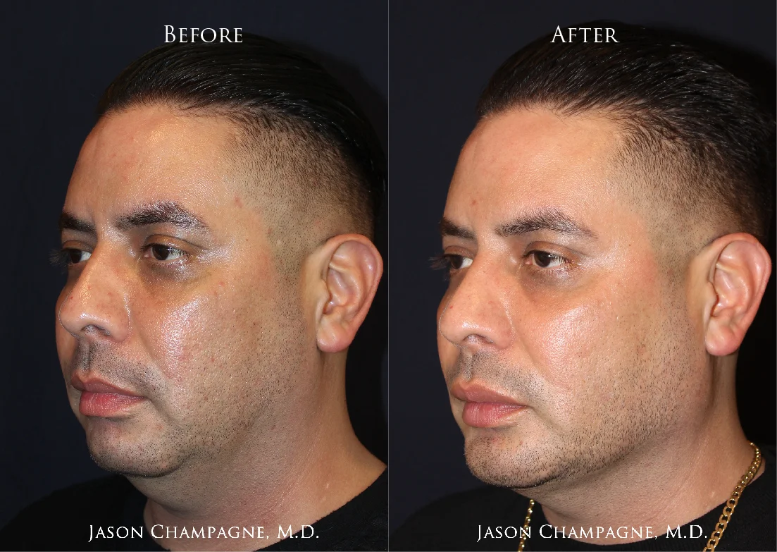 Custom Chin and Jaw Implants Gallery | Beverly Hills Plastic Surgeon ...