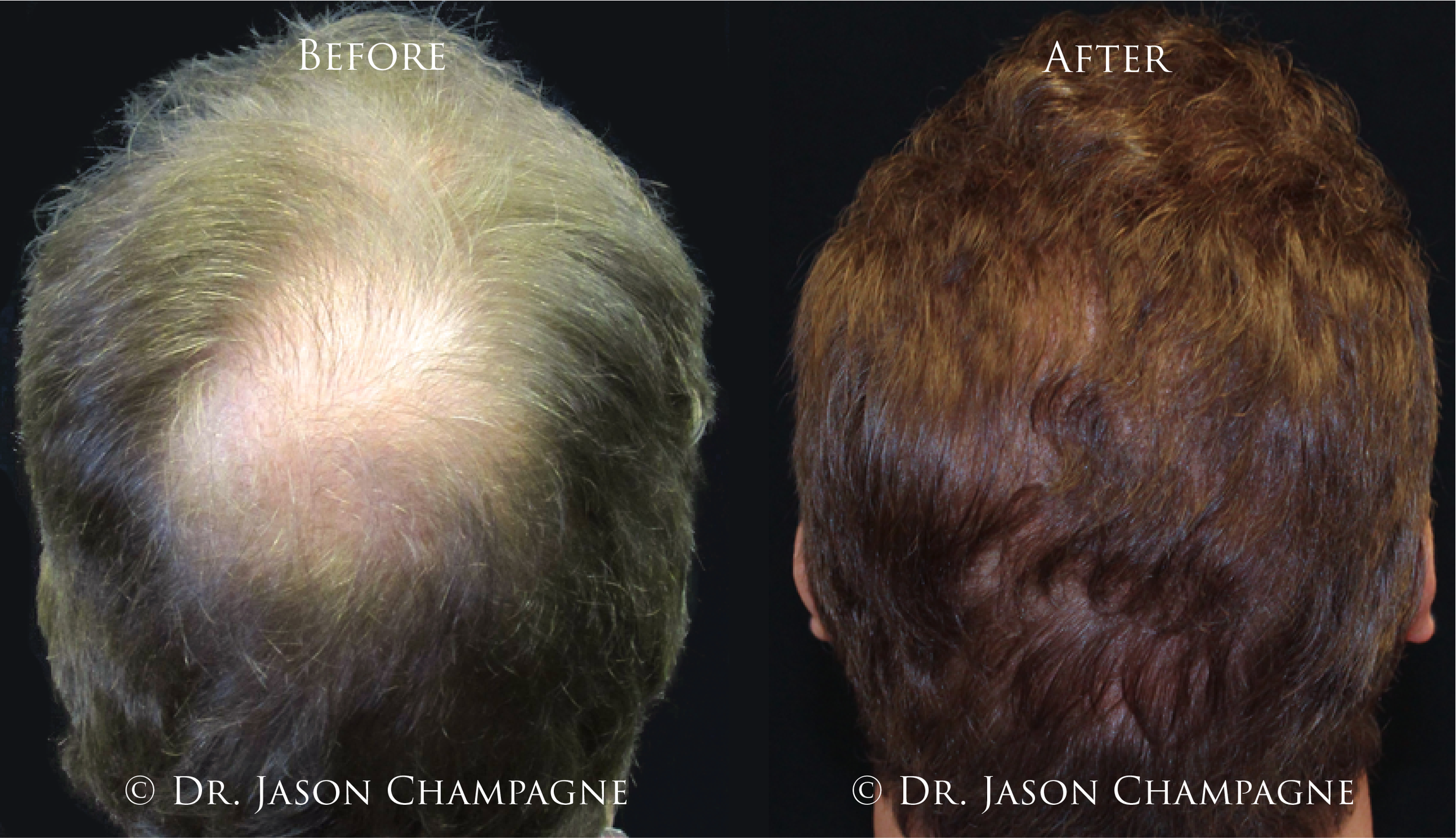 Hair Transplantation Gallery | Beverly Hills Plastic Surgeon - Dr ...