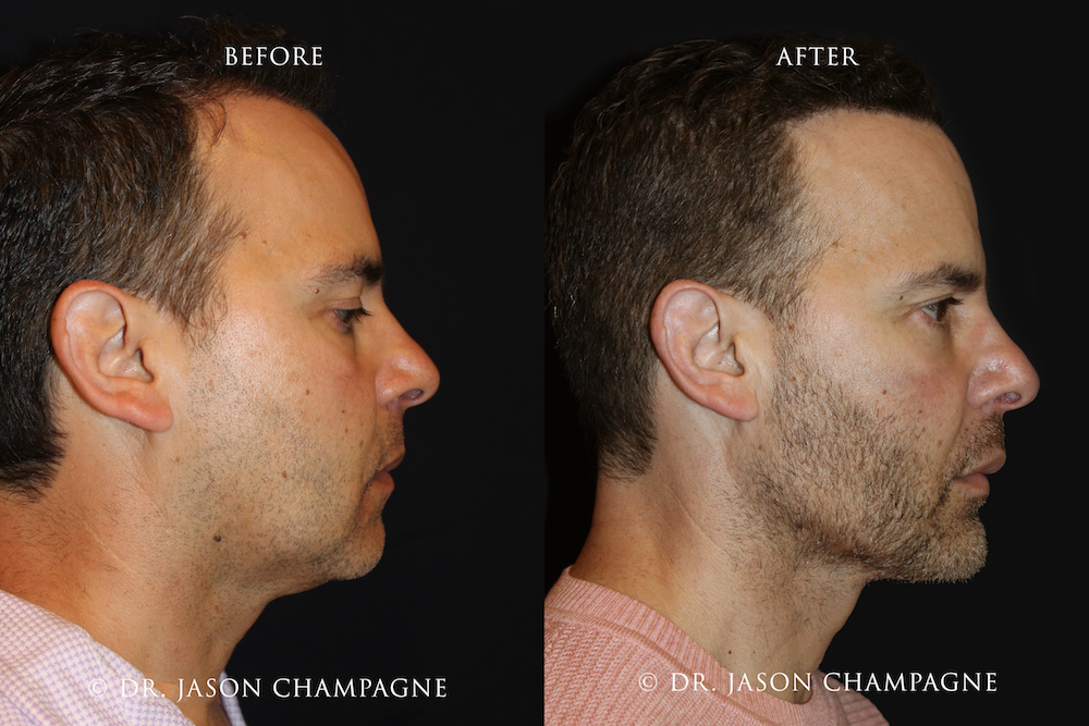 Beverly Hills Plastic Surgery Before and After - Dr. Jason Champagne