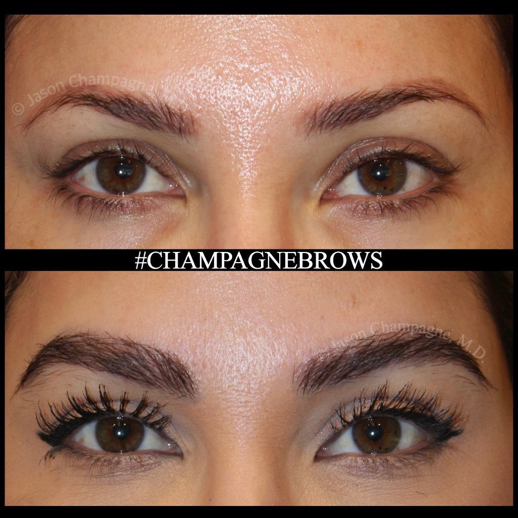 Eyebrow Hair Transplantation Gallery | Beverly Hills Plastic Surgeon ...