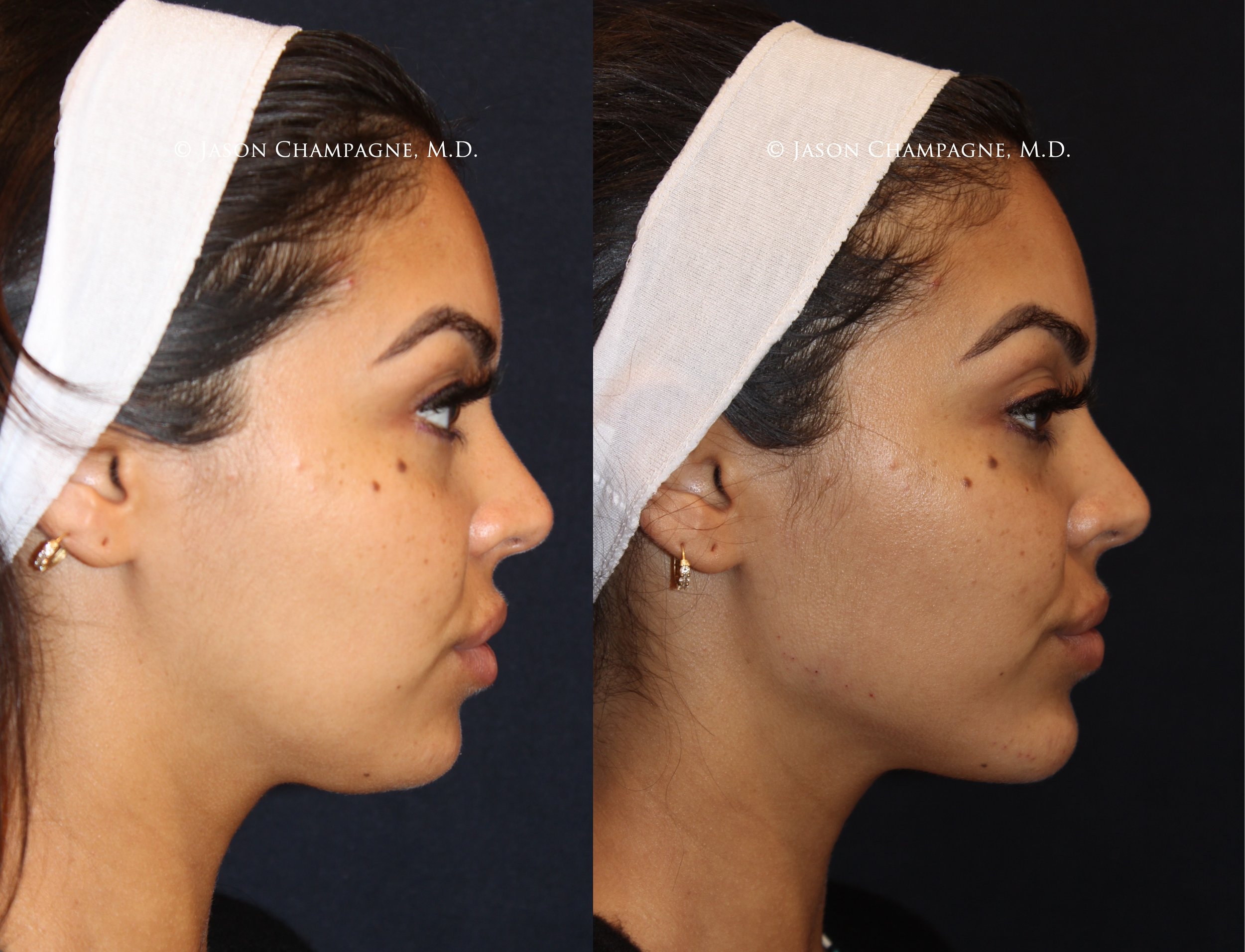 Face Contouring Before And After