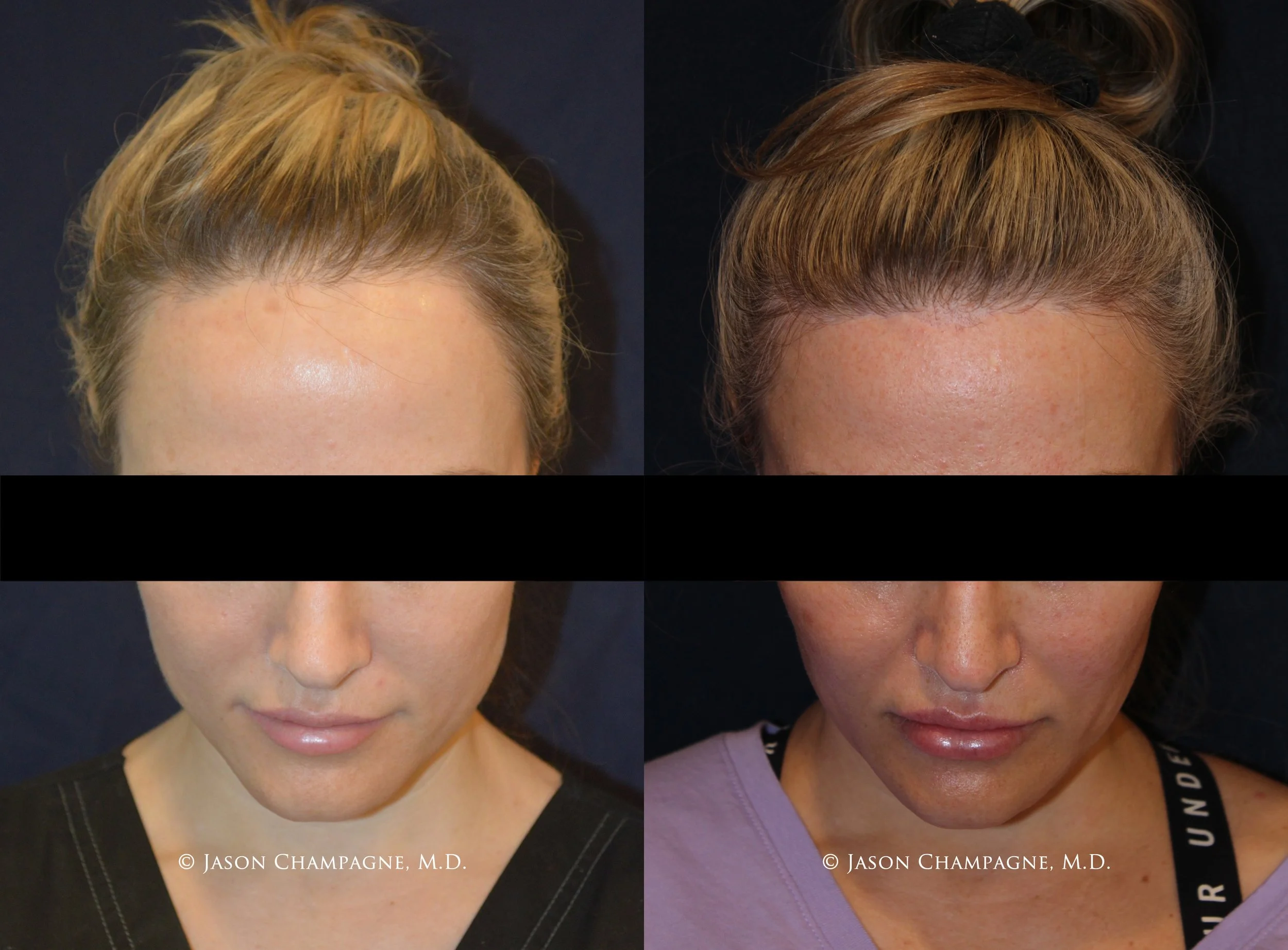 Hairline Lowering Gallery | Beverly Hills Plastic Surgeon - Dr. Jason ...