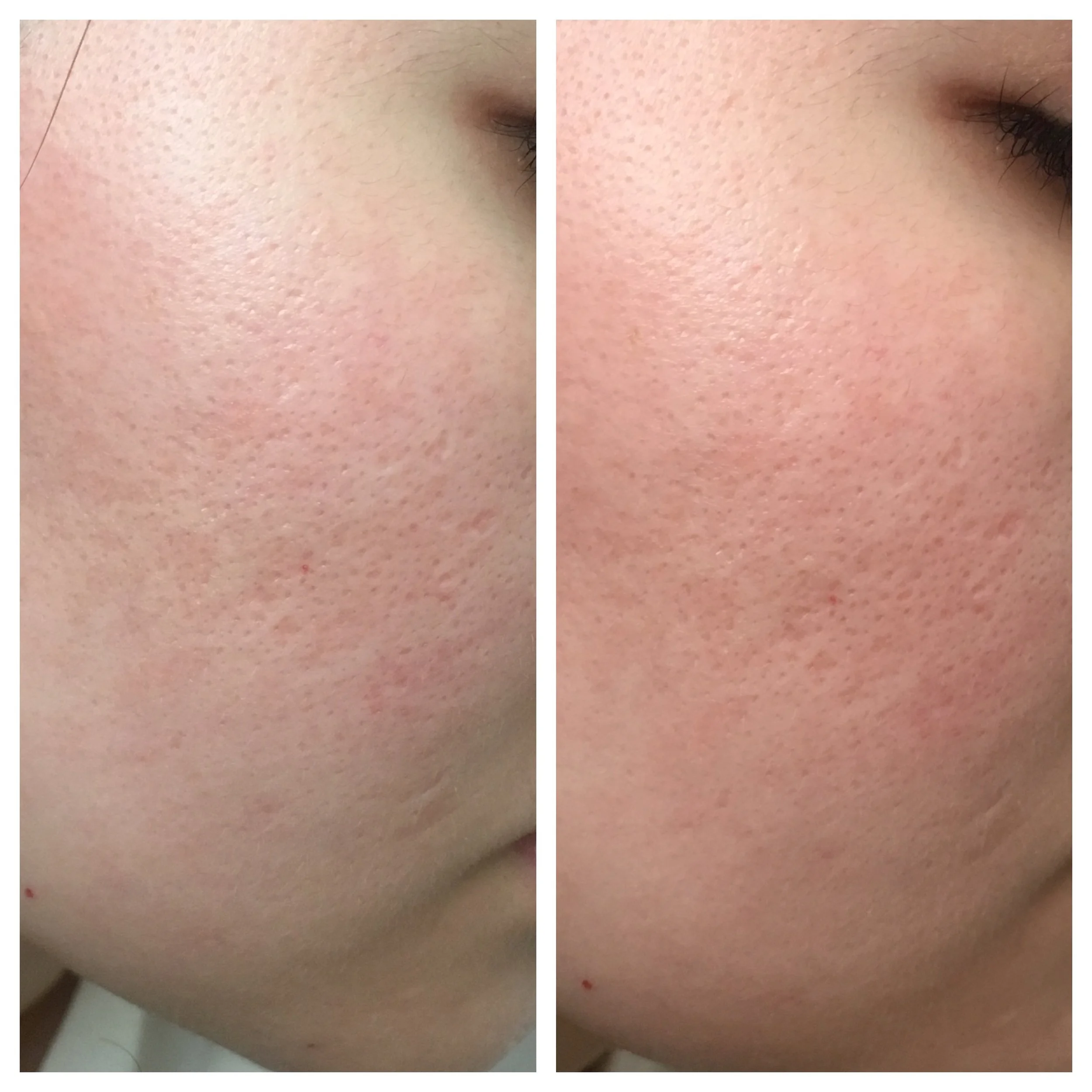 Mehr Als Alles Psychologisch Prinzip Co2 Fractional Laser Before And