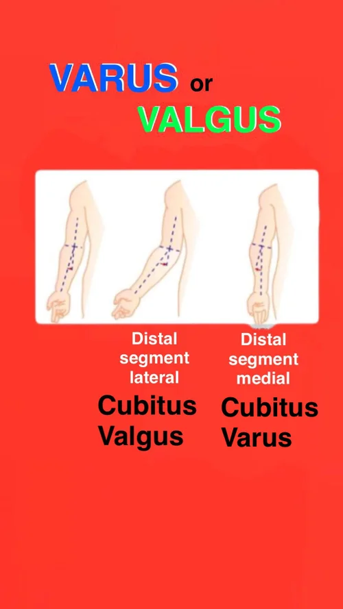 Varus Vs Valgus