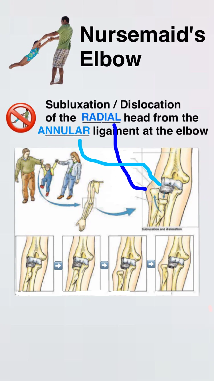Nursemaid's Elbow — JMcAfeePT.com