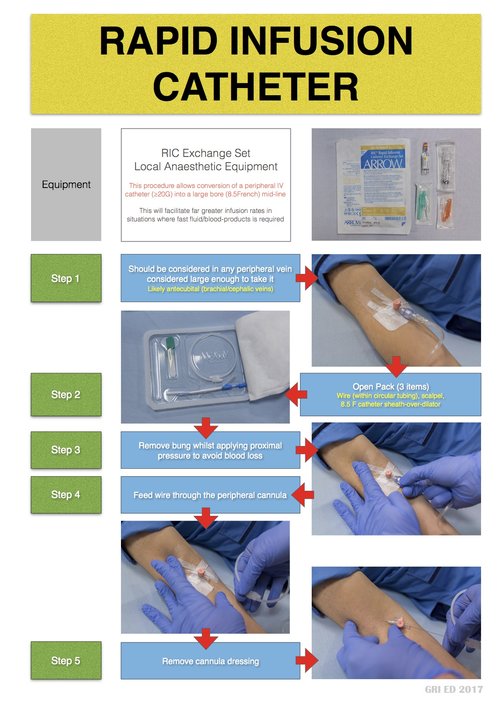 st mungo's-Rapid Infusion Catheter