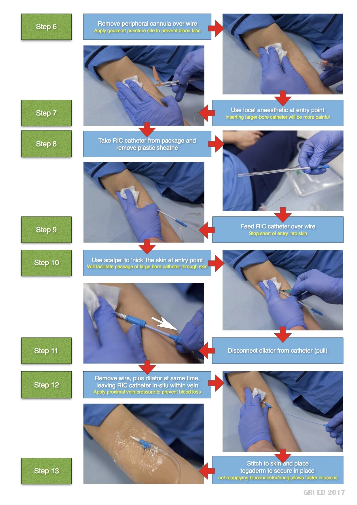 st mungo's-Rapid Infusion Catheter
