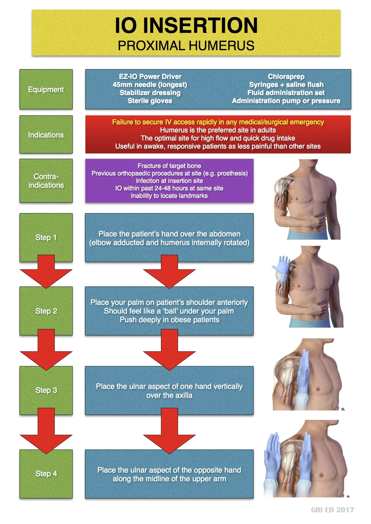 st mungo's-Humeral IO
