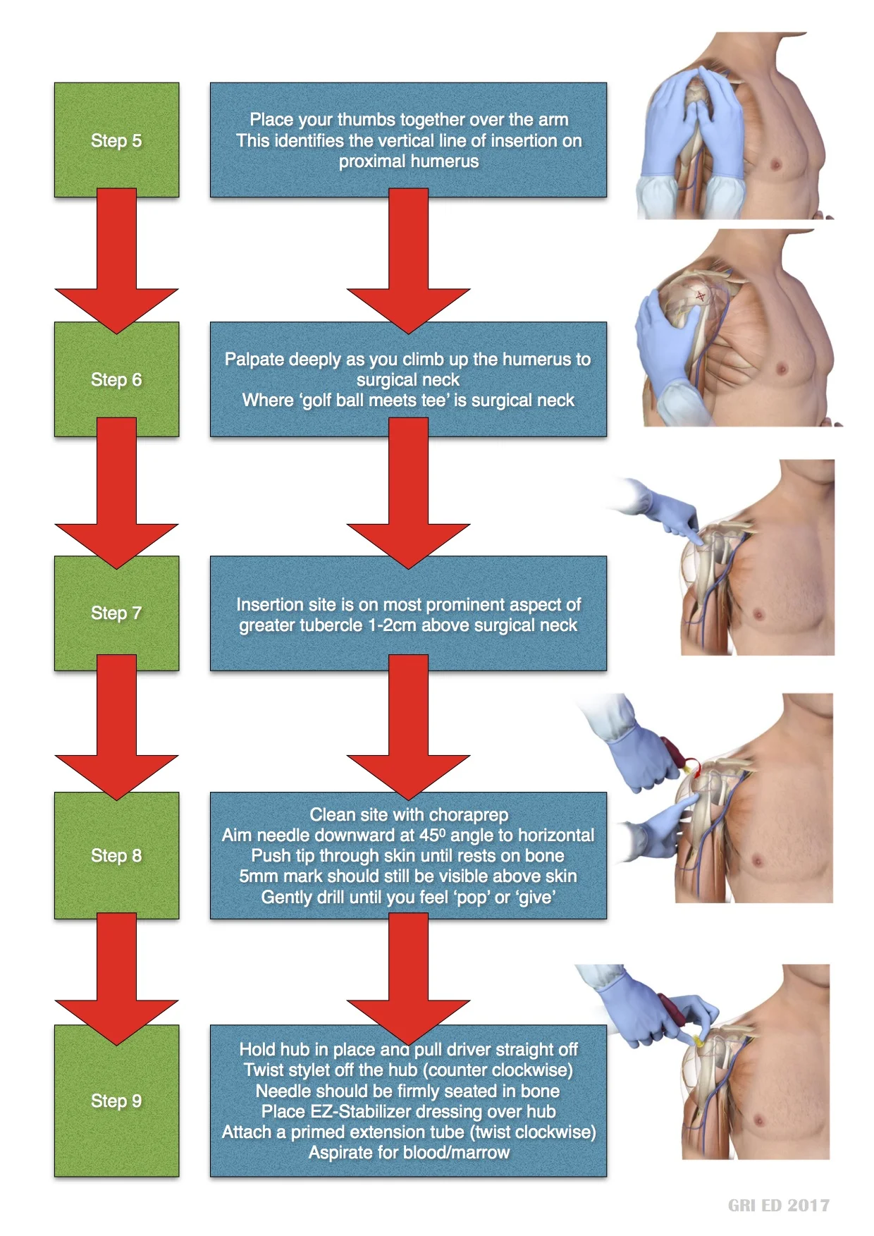 St Mungo s Humeral IO st-mungo-s-humeral-io
